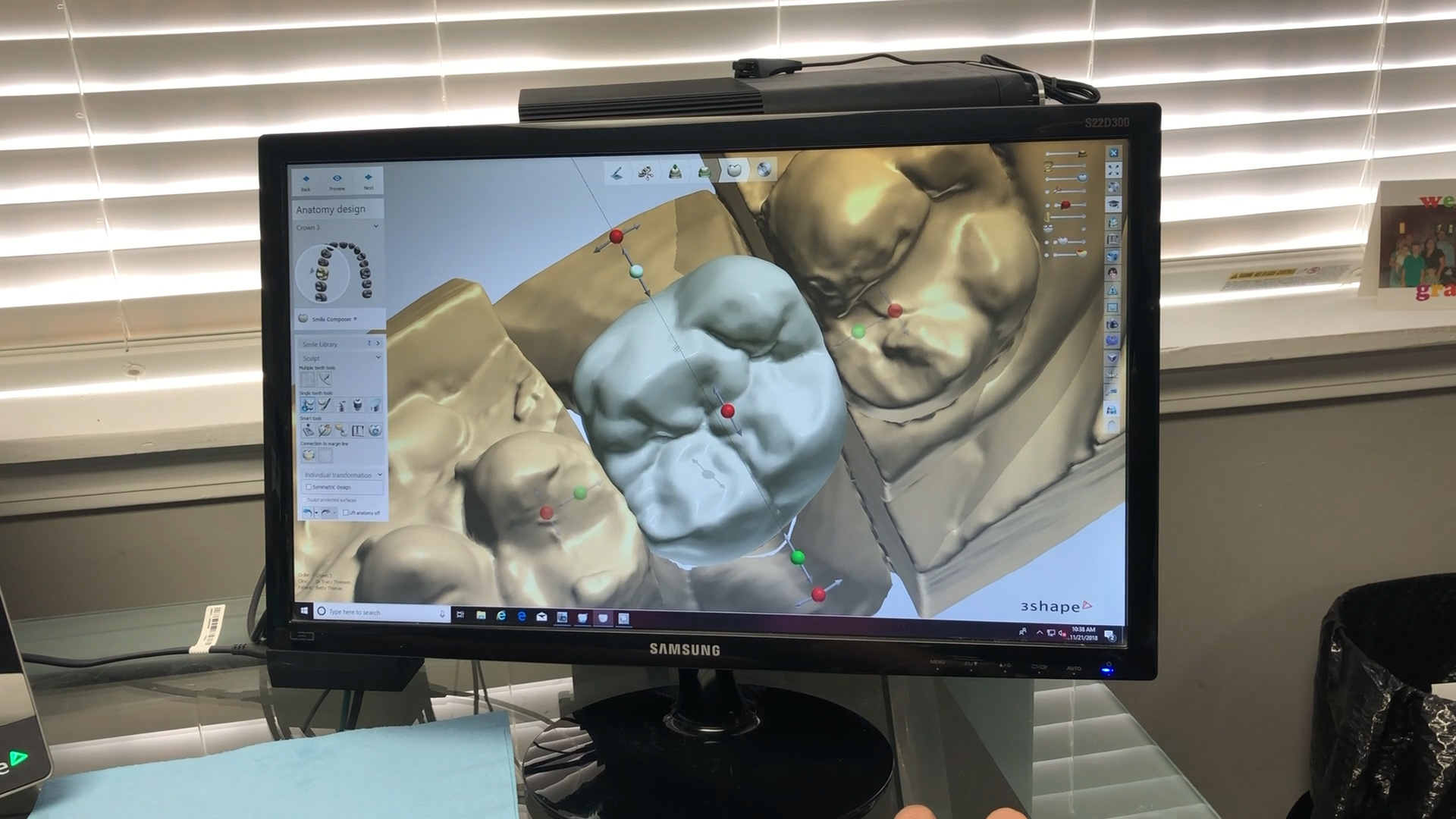 How our crowns are made - AdVance Dental PC | Dentist Birmingham AL